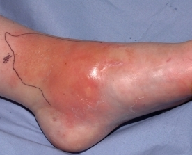 Cellulitis – Amytomically