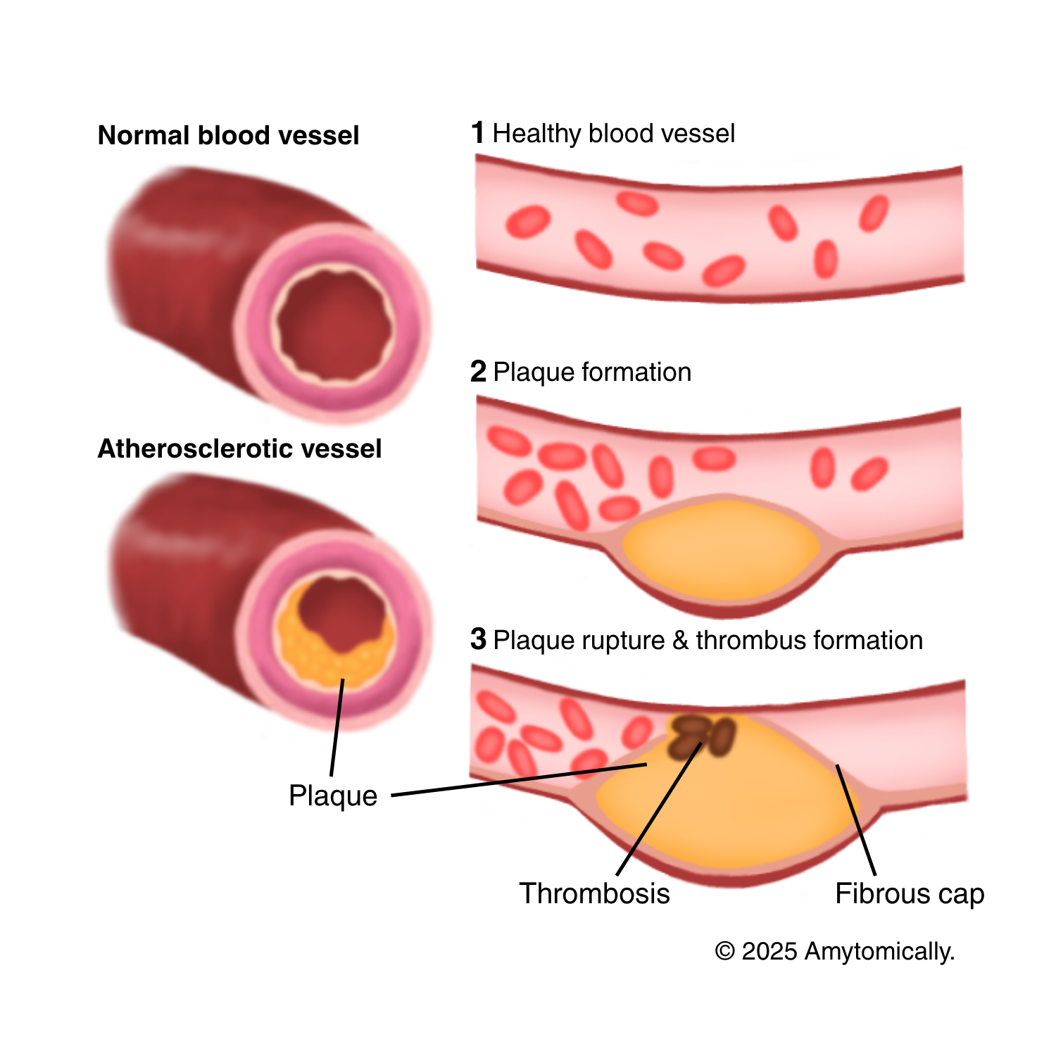 Atherosclerosis – Amytomically
