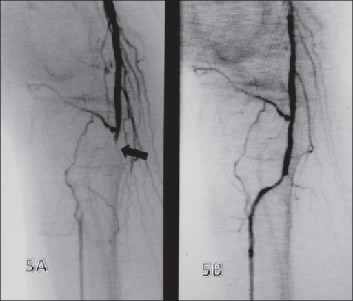 Peripheral Arterial Disease (PAD) – Amytomically