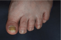 Nail Anatomy – Amytomically