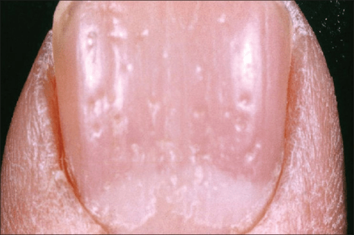 Nail Anatomy – Amytomically