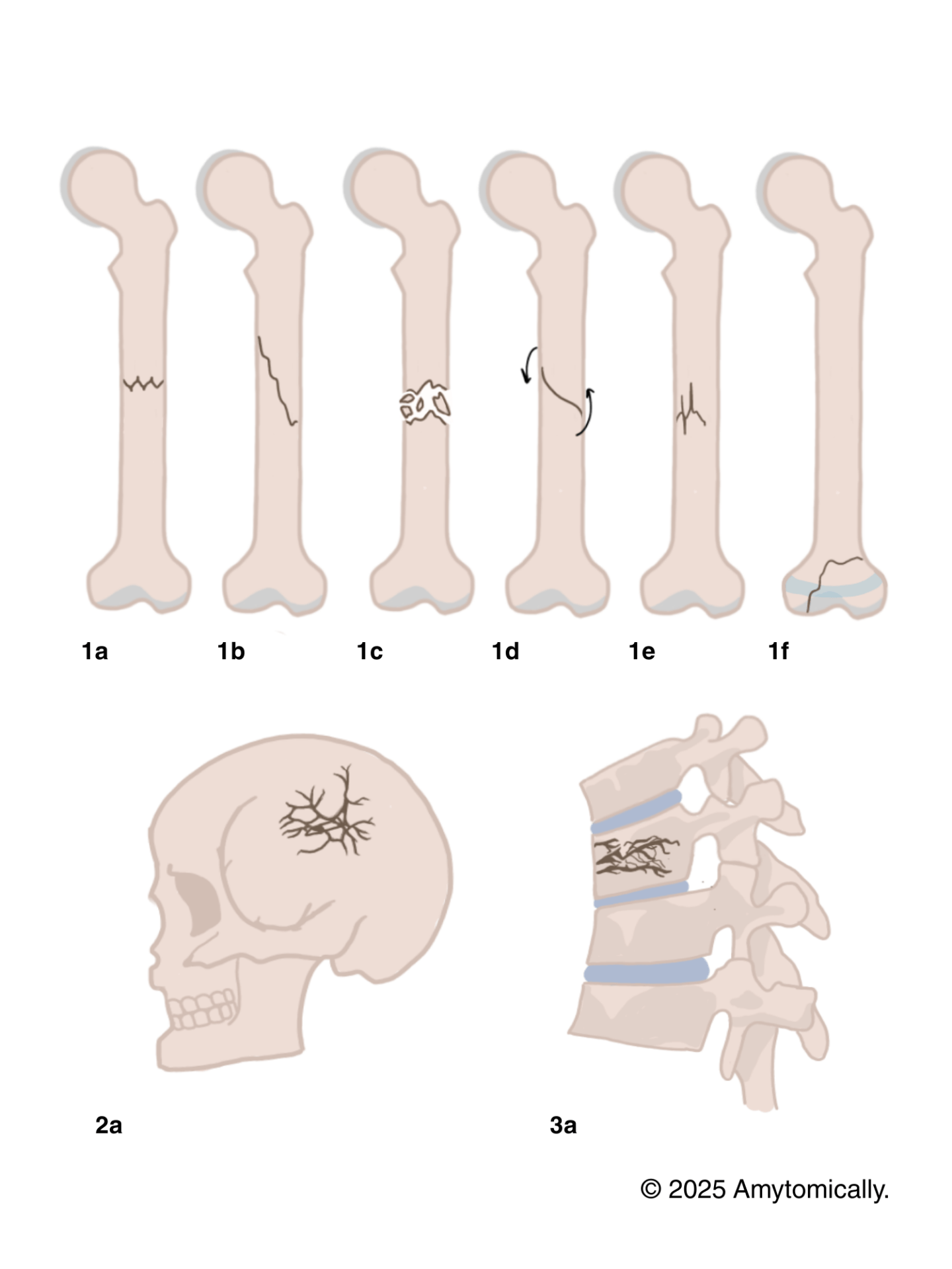 Fractures – Amytomically