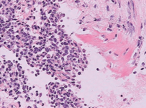 Ewing Sarcoma – Amytomically