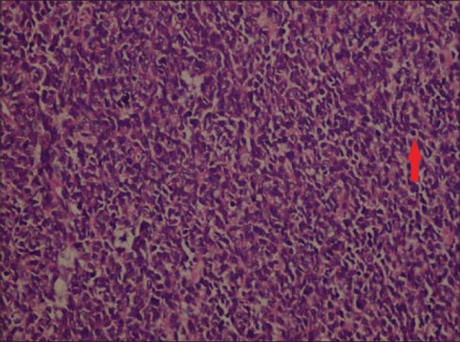 Ewing Sarcoma – Amytomically